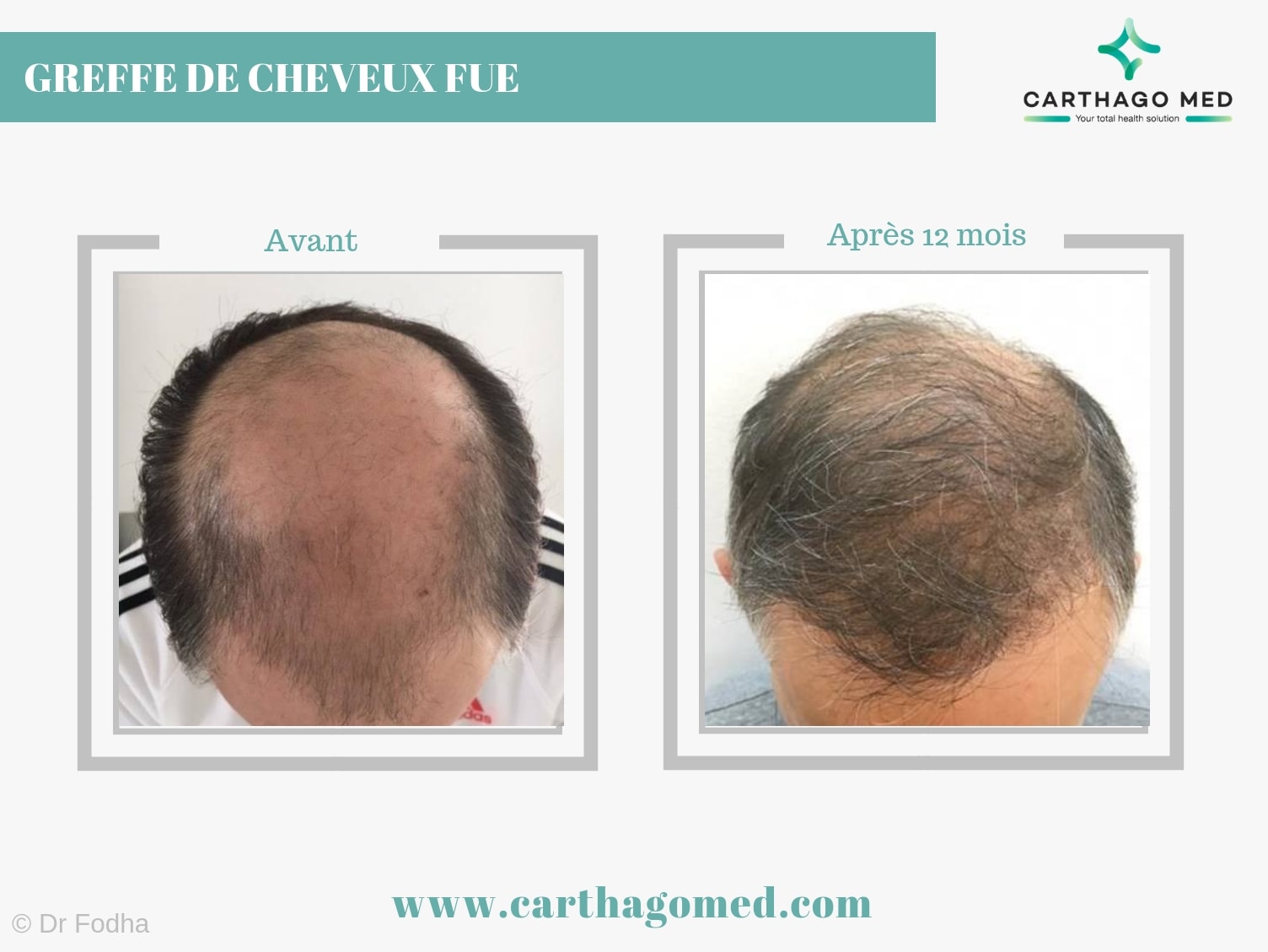 Greffe de Cheveux Tunisie - Implant Capillaire FUT - FUE Carthago Med
