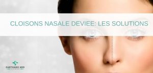 Traitement d'une déviation de la cloison nasale (septoplastie)