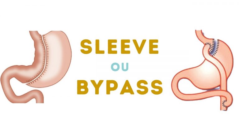 Quelles différences entre sleeve gastrectomie et bypass gastrique