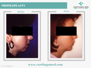 Face Surgery Before And After | CARTHAGO MED